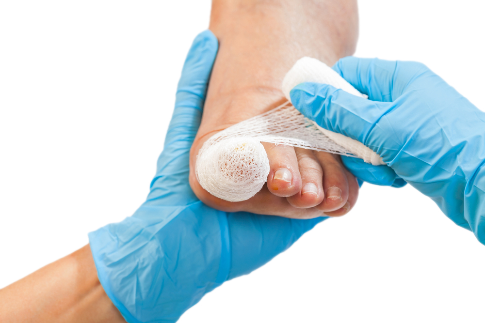 Nail Surgery | Stepping Out Podiatry
